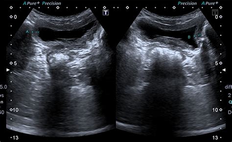 Effect Of Bladder Volume And Compliance On Ultrasonographic Measurement