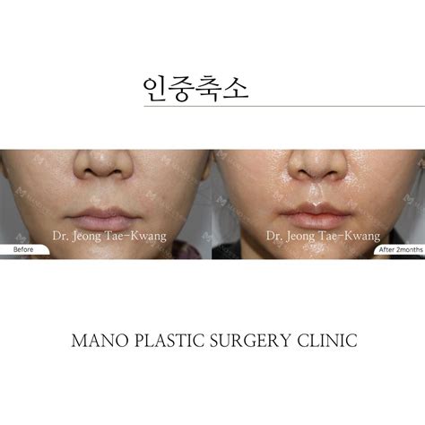 마노성형외과 동안성형종류 중 인중축소수술 알아보기 관련 내용 자세히 알아보기