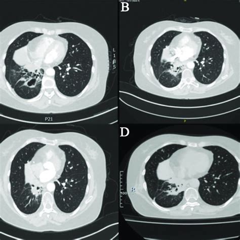 Treatment Course And Ctdna Ngs Test Results A The Complete Treatment