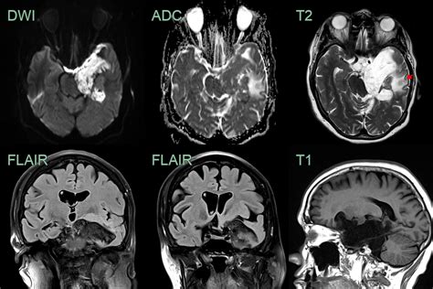 Epidermoid Cyst Neuroradiology