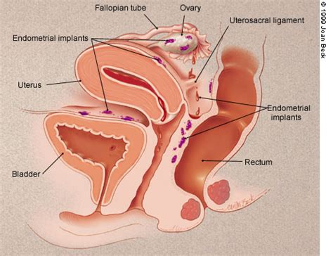 Diagnosis And Treatment Of Endometriosis Aafp