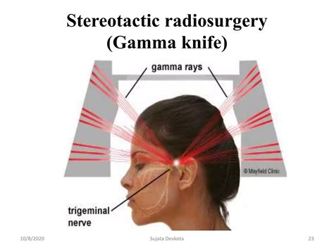 Trigeminal Neuralgia And Bells Palsy Pptx