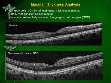 Role Of Oct In Glaucoma Pptx