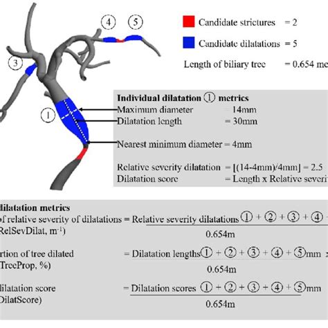 Biliary Tree Model Demonstrating Candidate Strictures And Dilatations