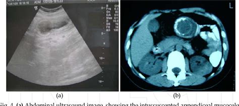 Figure 1 From Appendiceal Intussusception Semantic Scholar