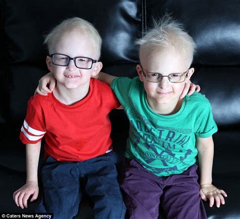 Ectodermal Dysplasia Teeth