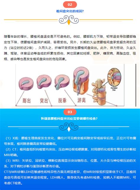 腰椎间盘突出症健康讲堂健康教育邹城市人民医院