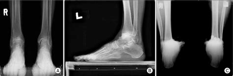 Before Performing Arthroscopic Ankle Arthrodesis Ankle Anteroposterior Download Scientific