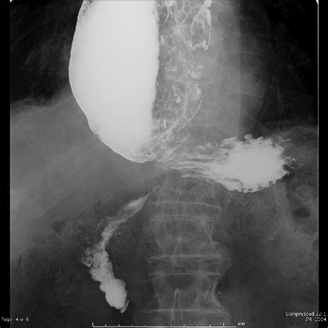 Barium Swallow Showing A Dilated Esophagus With Gastroesophageal Download Scientific Diagram