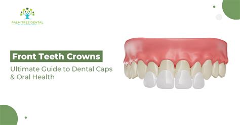 Front Teeth Crowns Ultimate Guide To Dental Caps And Oral Health Palm