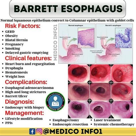 Barret Esophagus Medizzy