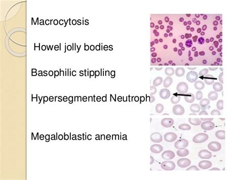 Pancytopenia