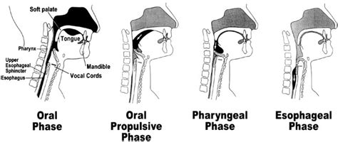 Dysphagia And Swallowing Dysphagia Medical Term Bsbf