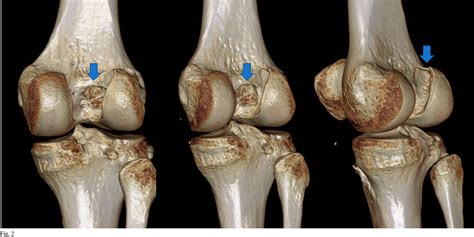 Figure 2 From Management Of Bone Loss And Tunnel Widening In Revision Acl Reconstruction