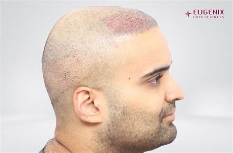 Pratik Agarwal Norwood Class 3 Hair Transplant Results And Hair