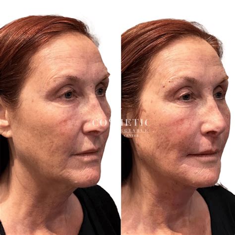 Barbed Pdo Threads Cost Benefits Procedure Before And After