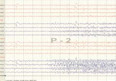 Ictal Eeg Showing A Typical Rhythmic Buildup Of 5 7 Hz Theta Activity Download Scientific