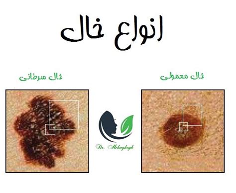 مرکز برداشتن خال در تهران دکتر کاظم محقق