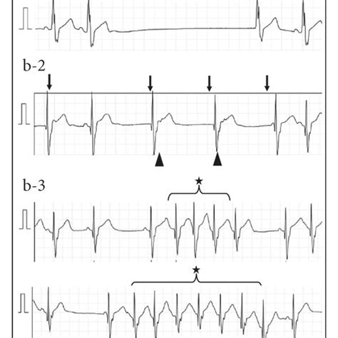 Flutter auricular típico antihorario Download Scientific Diagram