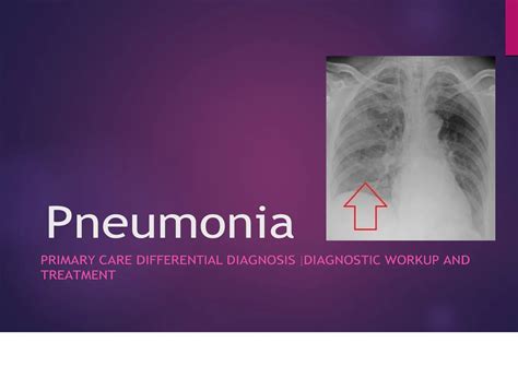 Pneumonia Primary Care Differential Diagnosis Diagnostic Workup And Treatment Pneumonia
