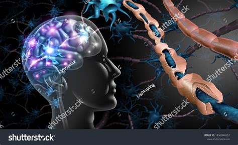 Multiple Sclerosis Nerve Disorder Damaged Myelin Stock Illustration Shutterstock