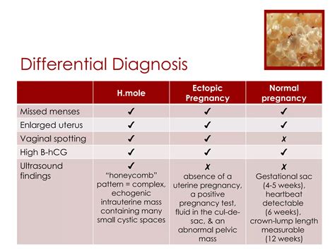 Molar Pregnancy Ppt