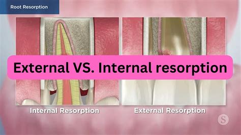Internal Vs External Resorption In Dentistry Youtube