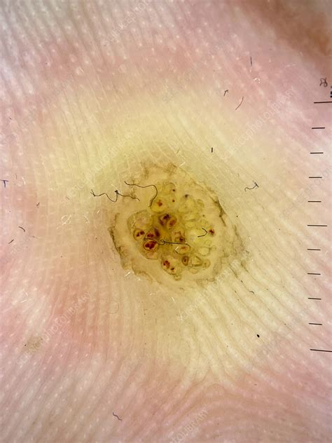 Wart Dermoscopy Stock Image C0572428 Science Photo Library