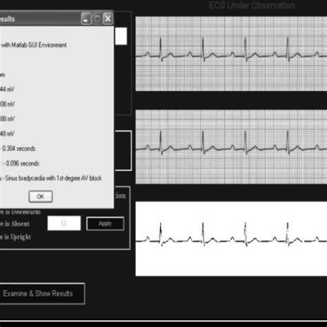 An Ecg Sample Analysis And Analysis Result Download Scientific Diagram