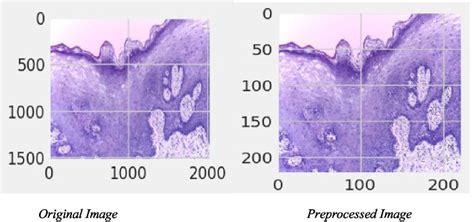 Oral Squamous Cell Carcinoma Detection Using Efficientnet On Histopathological Images Pmc