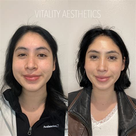 What To Expect From Jaw Botox Vitality Aesthetics