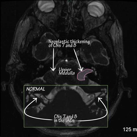 Neuroanatomy Glossary 7th Nerve Palsy Ditki Medical And Biological Sciences