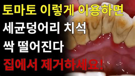 집에 토마토가 있다면 이렇게 하세요 잇몸뼈를 녹일 수 있는 치석돈 들이지 않고 집에서 제거할 수 있습니다토마토만 있으면 됩니다 Youtube