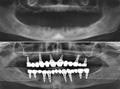Full Mouth Dental Implant Meet Dr Rahman For Dental Implant