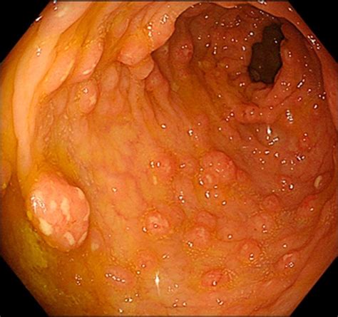 Colonoscopy Showing Polypoid Lesions Varied In Size From 0 5 To 1 Cm Download Scientific