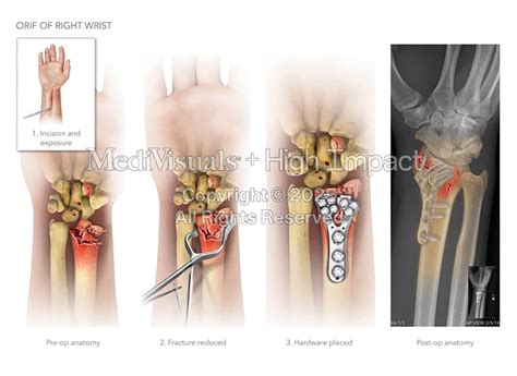 Open Reduction Internal Fixation Of The Right Wrist Medivisuals High Impact