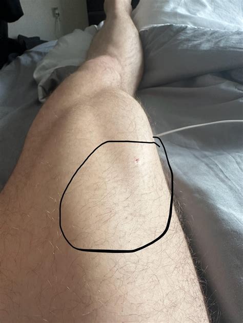 Correct Spot For Trt Injection R Trt