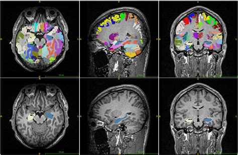brain structure parcellation obtained through individual brain atlases