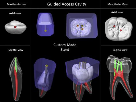 Access Cavity Preparations Classification And Literature Review Of
