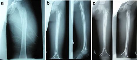 Radiographs Of A Left Femur With A Complex Proximal Spiroid Fracture Of