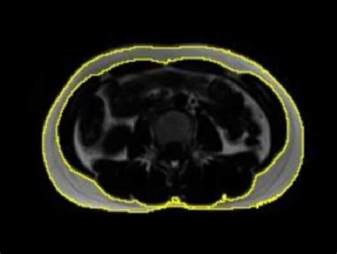 The Abdominal Subcutaneous Adipose Area Sat A And The Visceral