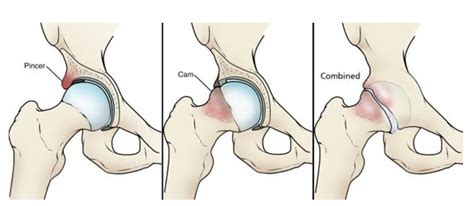 Hip Pain Understanding Femoral Acetabular Impingement Pakenham