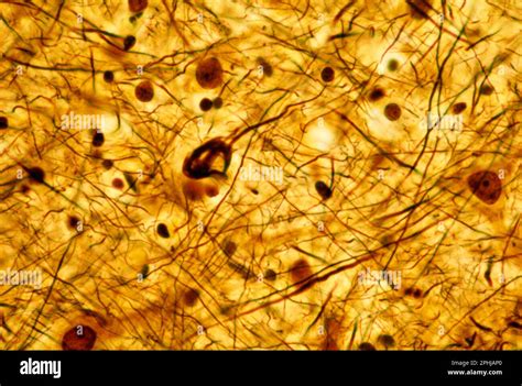 Neurofibrillary Tangles In Pyramidal Neuron Light Micrograph Stock Neurofibrillary Tangles In Pyramidal Neuron Light Micrograph Stock