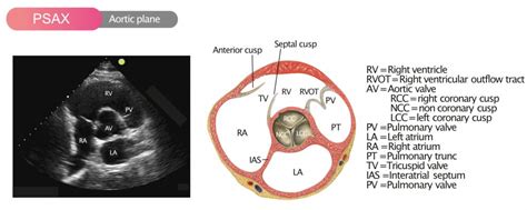 Cardiac Echo Parasternal Short