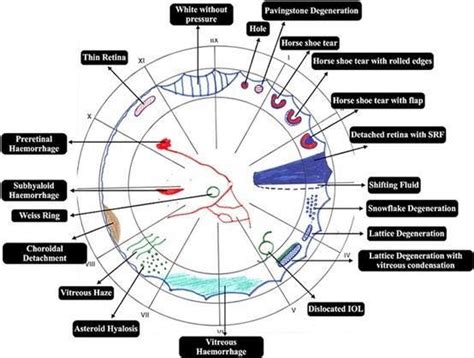 Color Coding Of Retina Ophthalmology Notes And Synopses