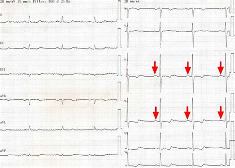Interatrial Block Ecg Book