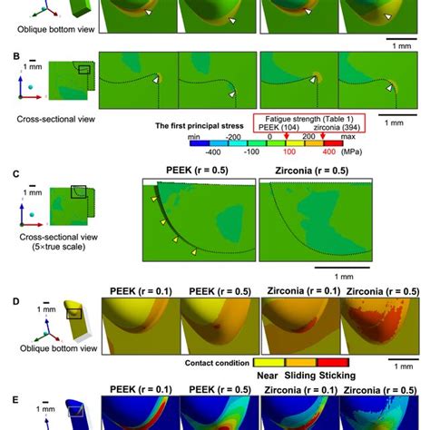 First Principal Stress Distribution From A An Oblique Bottom View And Download Scientific