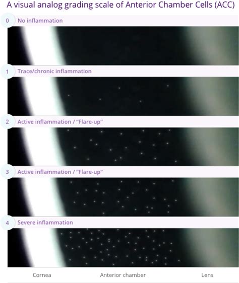 Uveitis Uveitic Glaucoma