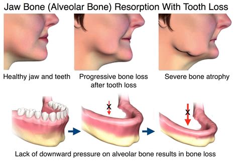 Jaw Bone Health In Ventura Ca Oral Health And Jaw Bone Disease