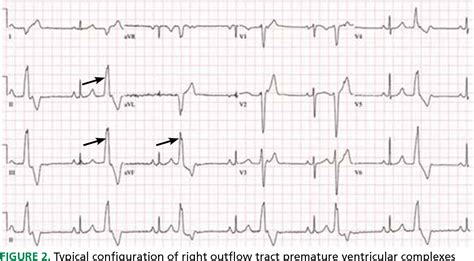 Premature Ventricular Contraction
